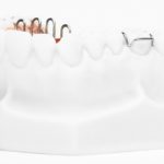 Tongue Crib – BM Ortho Appliances Inc.