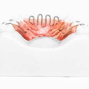Tongue Crib – BM Ortho Appliances Inc.