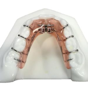 Schwartz Expander Upper – Lower – BM Ortho Appliances Inc.