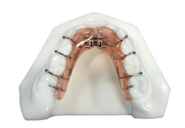 Schwartz Expander Upper – Lower – BM Ortho Appliances Inc.