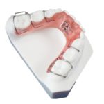 Schwartz Expander Upper – Lower – BM Ortho Appliances Inc.