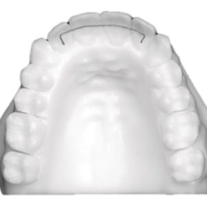 Fixed Bonded Retainer Upper – Lower – BM Ortho Appliances Inc.