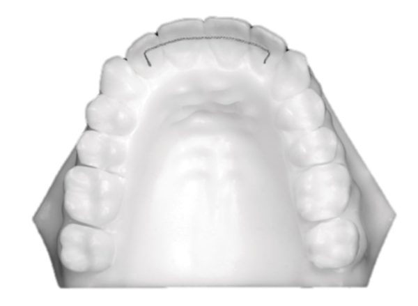 Fixed Bonded Retainer Upper – Lower – BM Ortho Appliances Inc.