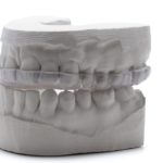 Night Guard – BM Ortho Appliances Inc.