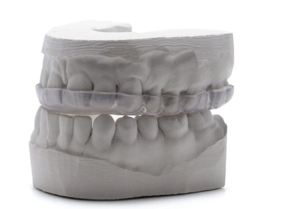 Night Guard – BM Ortho Appliances Inc.