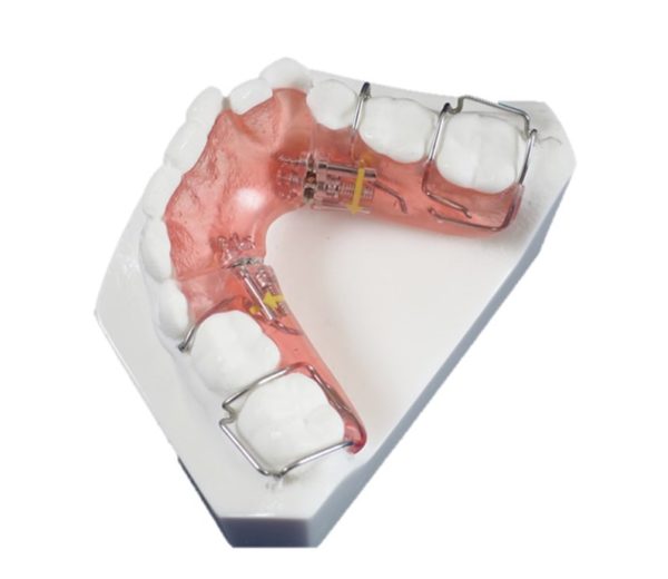 Sagittal Expander Upper – Lower – BM Ortho Appliances Inc.