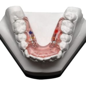 Sagittal Expander Upper – Lower – BM Ortho Appliances Inc.
