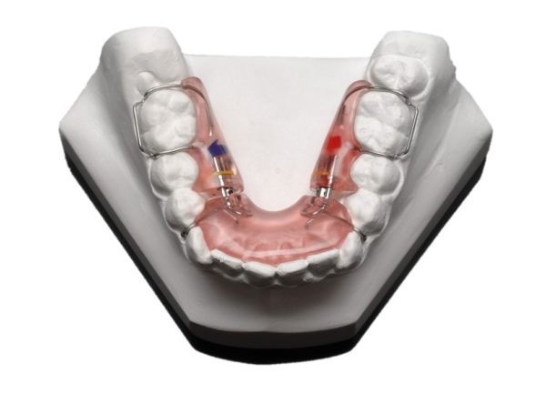 Sagittal Expander Upper – Lower – BM Ortho Appliances Inc.