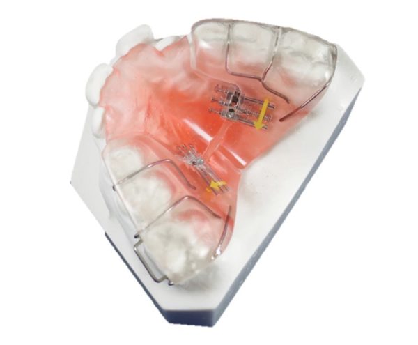 Sagittal Expander Upper – Lower – BM Ortho Appliances Inc.