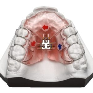 3 Way Expander – BM Ortho Appliances Inc.