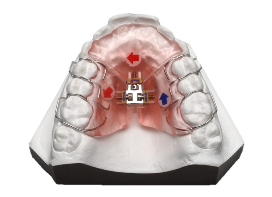 3 Way Expander – BM Ortho Appliances Inc.