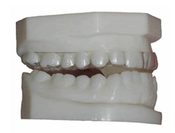 Acrylic Cross-bite – BM Ortho Appliances Inc.