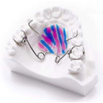 Hilgers Pendulum Appliance – BM Ortho Appliances Inc.