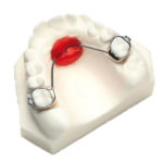 Nance Appliance – BM Ortho Appliances Inc.