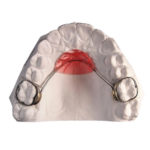 Nance Appliance – BM Ortho Appliances Inc.