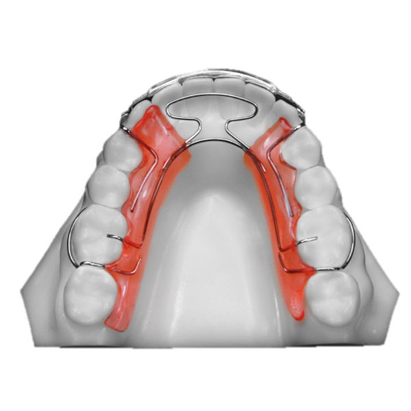 Open Spring Retainer – Upper – BM Ortho Appliances Inc.
