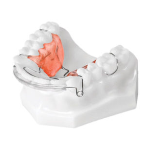 Open Spring Retainer – Upper – BM Ortho Appliances Inc.