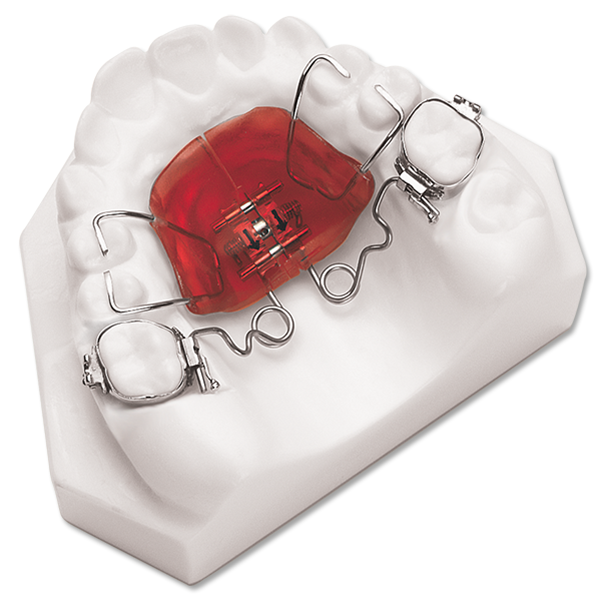 Hilgers Pendulum Appliance – BM Ortho Appliances Inc.