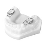 Band and Loop Space Maintainer – BM Ortho Appliances Inc.