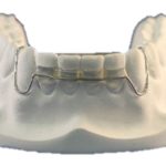 Spring Aligner with Acrylic Extension – BM Ortho Appliances Inc.