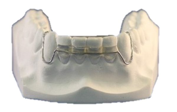 Spring Aligner with Acrylic Extension – BM Ortho Appliances Inc.