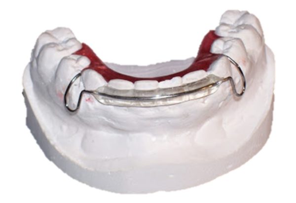 Spring Aligner with Acrylic Extension – BM Ortho Appliances Inc.