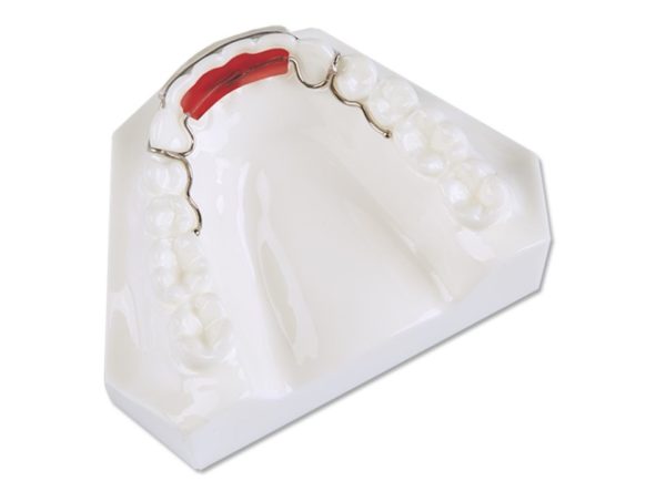 Spring Aligner with wire extension – BM Ortho Appliances Inc.