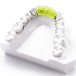 Spring Aligner with wire extension – BM Ortho Appliances Inc.