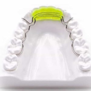 Spring Aligner with wire extension – BM Ortho Appliances Inc.