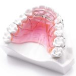 Super Spring Aligner – BM Ortho Appliances Inc.