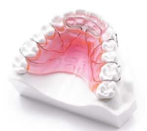 Super Spring Aligner – BM Ortho Appliances Inc.