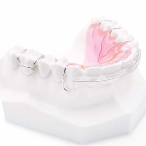 Super Spring Aligner – BM Ortho Appliances Inc.