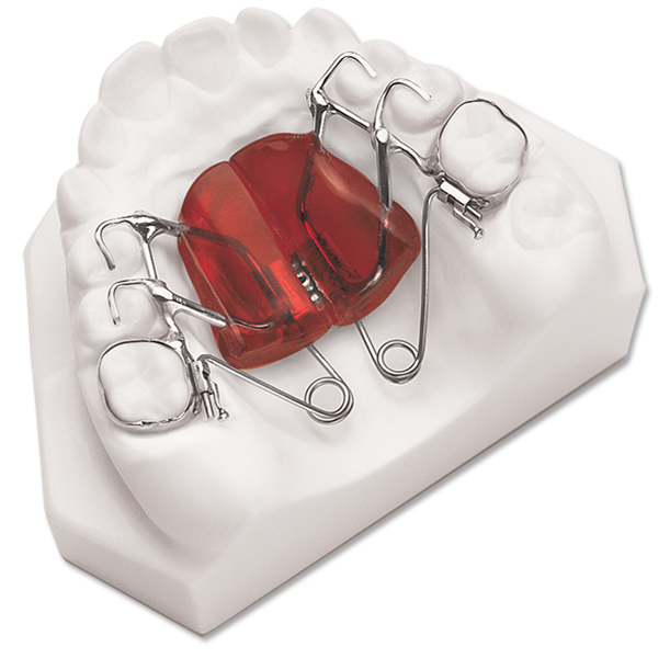 Hilgers Pendulum Appliance – BM Ortho Appliances Inc.