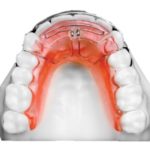 Spring Hawley Retainer Upper – Lower – BM Ortho Appliances Inc.