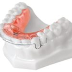 Spring Hawley Retainer Upper – Lower – BM Ortho Appliances Inc.