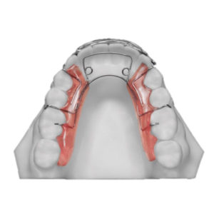 Premand Spring Retainer – BM Ortho Appliances Inc.