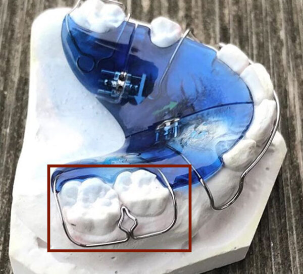 AccessoriesClasps in Removable Orthodontics – BM Ortho Appliances Inc.